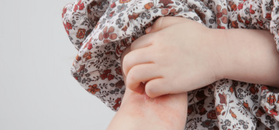 The Most Common Types of Bug Bites - Guides