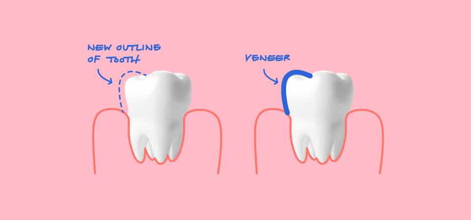 What It’s Like to Get Veneers - Advice