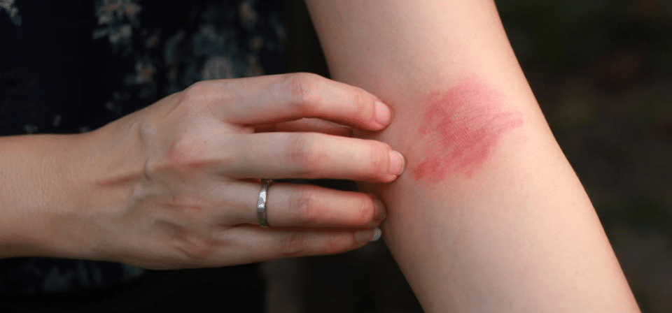 Common Types of Dermatitis and Different Treatment Options - Explainer